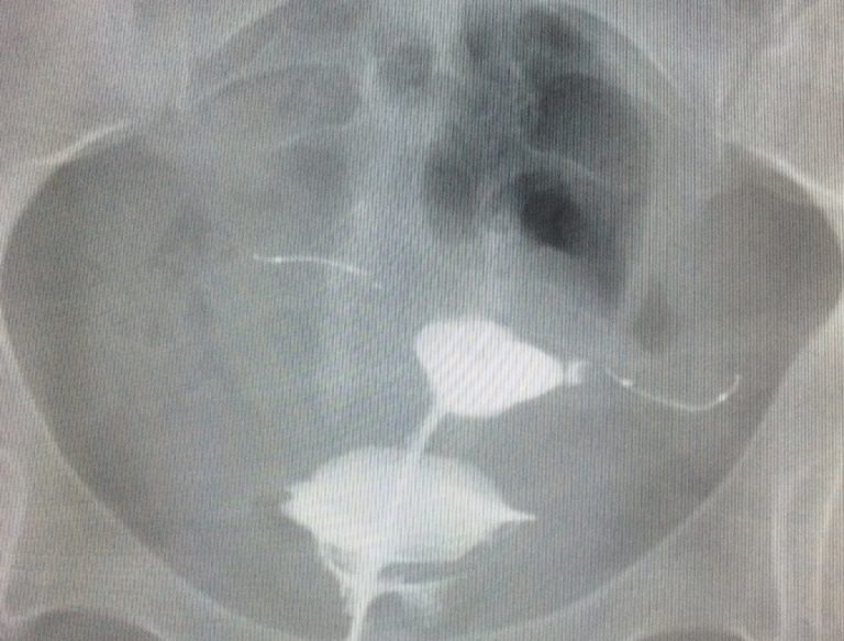 Four Tips for Performing a Hysterosalpingogram (HSG)